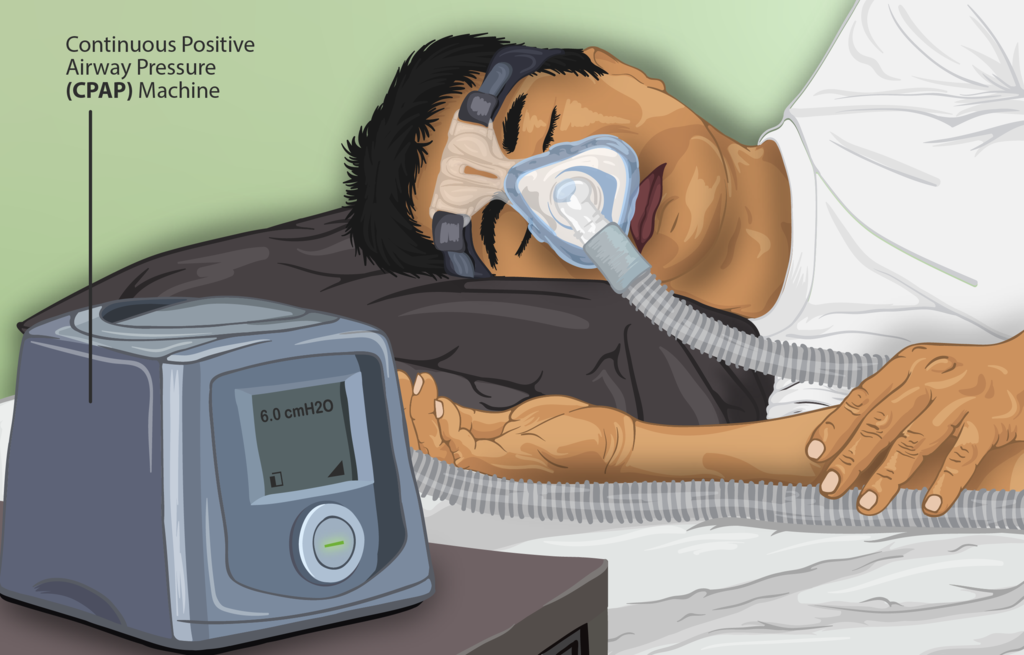 Does Medicare Cover CPAP Machines Grants For Medical